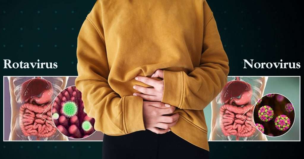 Rotavirus and Norovirus: Comparison of Symptoms