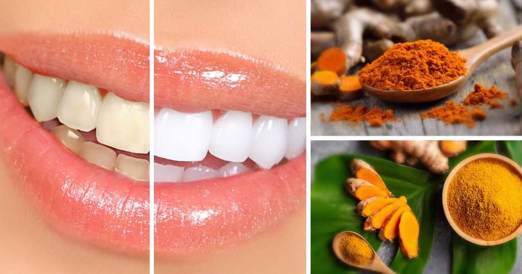 Using Turmeric for Teeth: Benefits and Application Tips